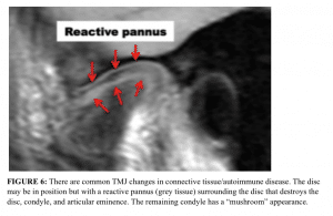 Total TMJ Replacement | Dr. Larry M. Wolford, DMD