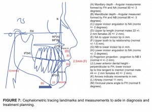 Total TMJ Replacement | Dr. Larry M. Wolford, DMD