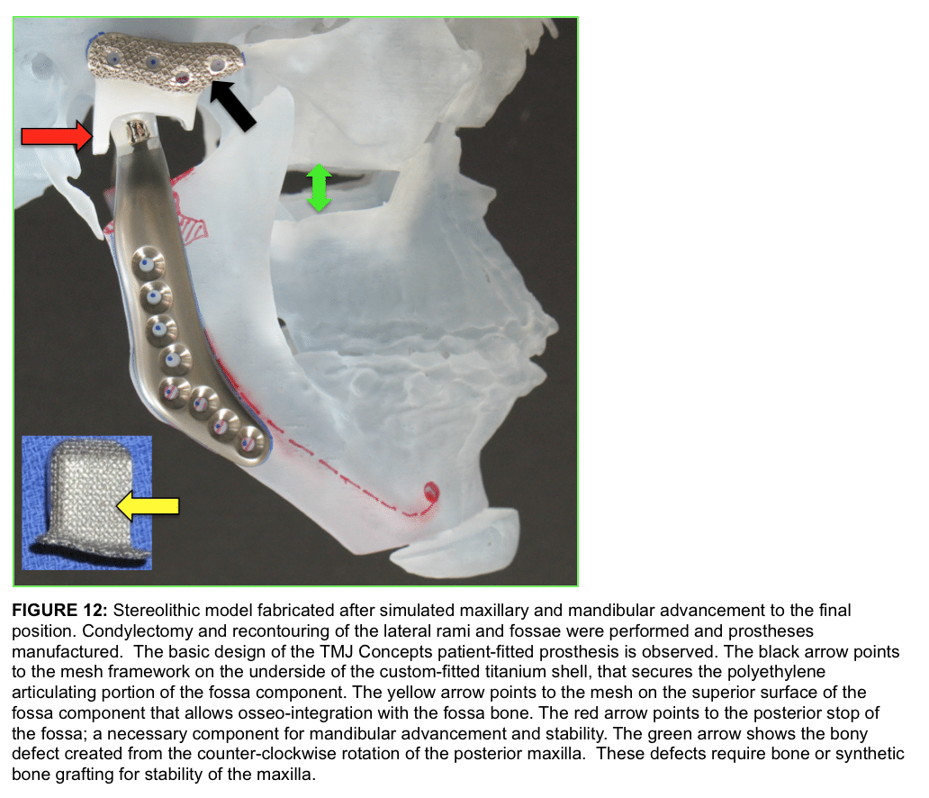 Total TMJ Replacement | Dr. Larry M. Wolford, DMD