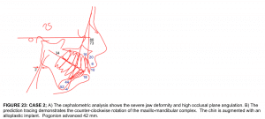 Total TMJ Replacement | Dr. Larry M. Wolford, DMD