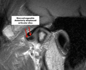MRI Evaluation for TMJ | Dr. Larry M. Wolford, DMD