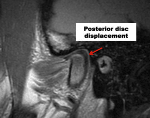 MRI Evaluation for TMJ | Dr. Larry M. Wolford, DMD