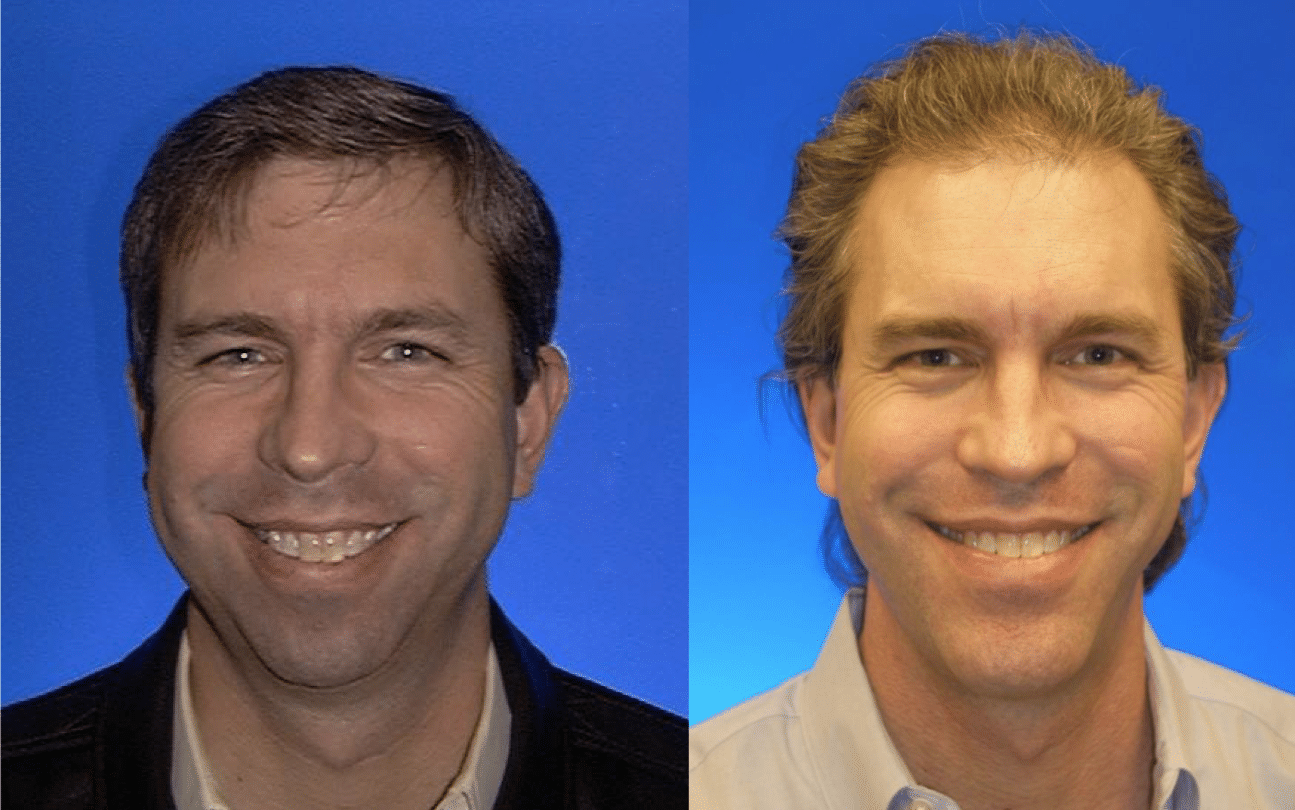 Before & After Case 1 Sleep Apnea Surgery | Dr. Larry M. Wolford, DMD