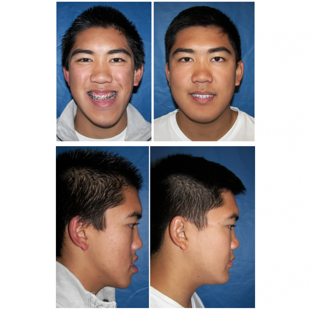 Before & After Surgery Photos | Dr. Larry M. Wolford, DMD