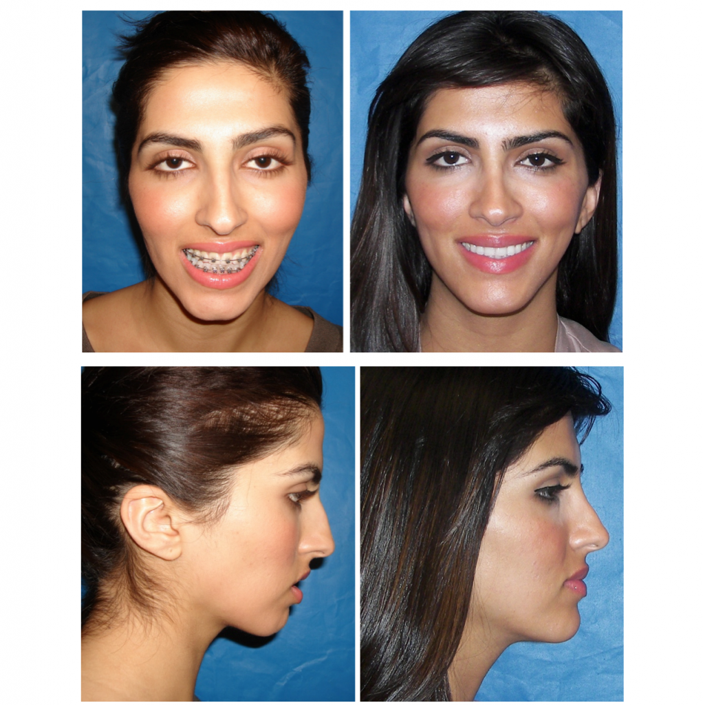 Before & After Surgery Photos | Dr. Larry M. Wolford, DMD