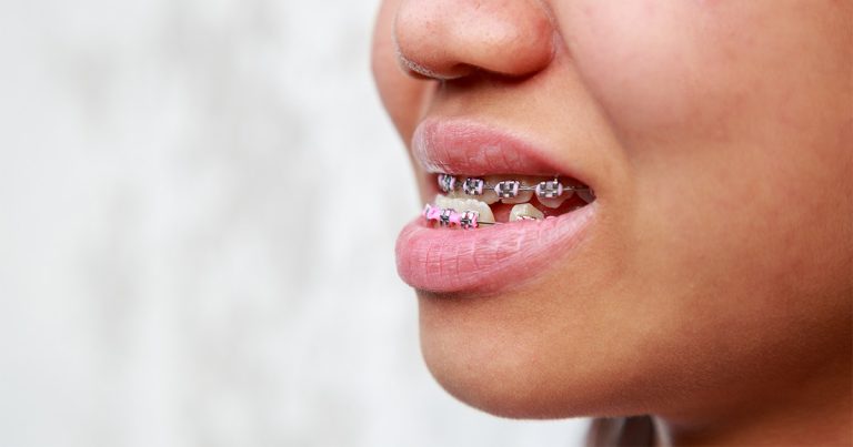 Protruding Lower Jaw: What Are My Options? | Dr. Larry M. Wolford, DMD